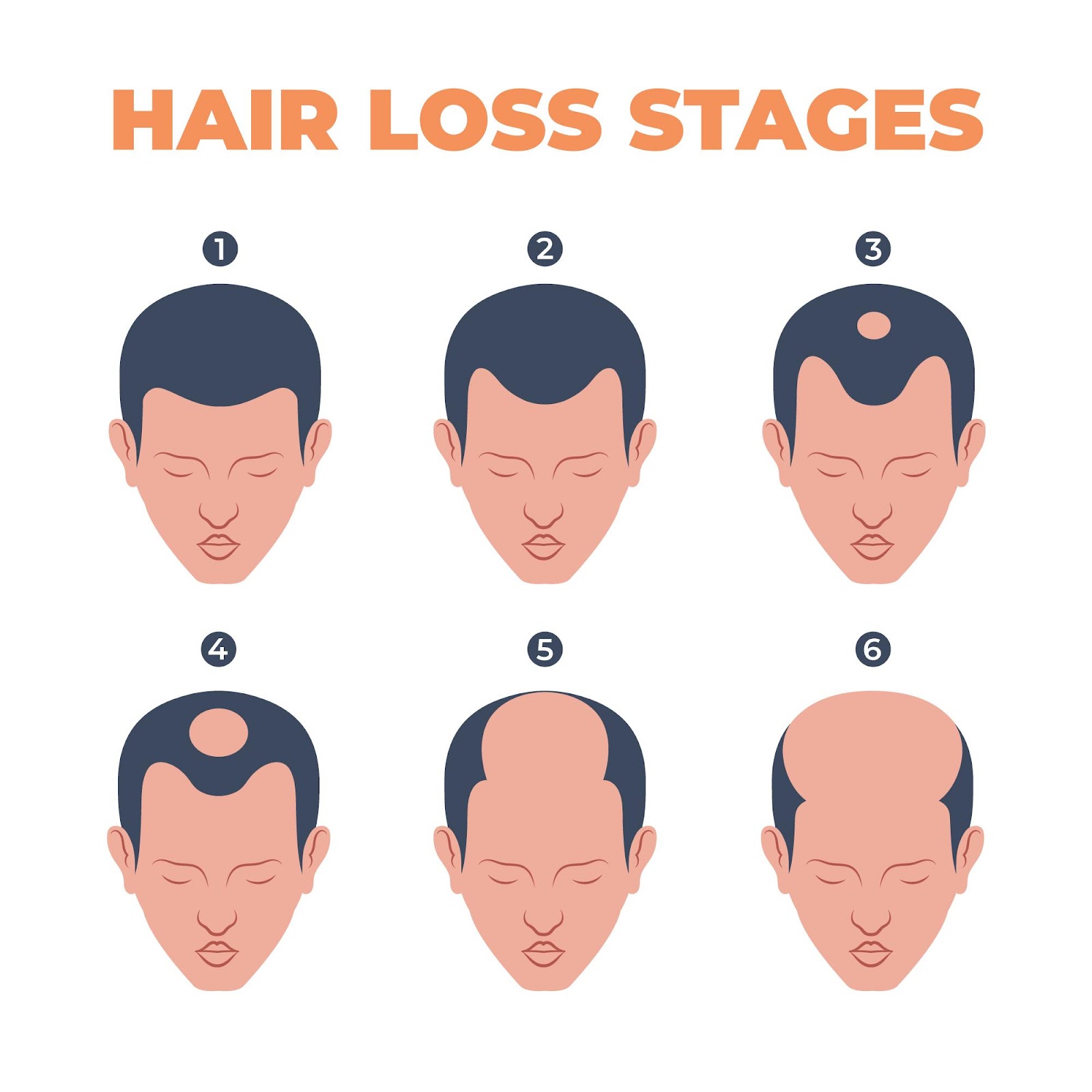Male Pattern Baldness Causes Stages And Treatment
